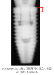 Nobel Parallel CC Implantについて | 歯と口腔外科の役立つお話