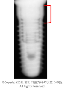 CAMLOG SCREW-LINE Implant について | 歯と口腔外科の役立つお話
