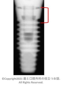 BioHorizons Straight Implant | 歯と口腔外科の役立つお話
