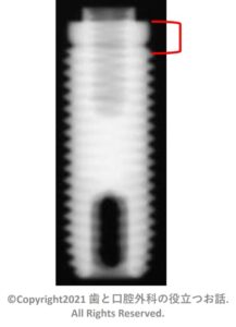 Taper Lock Screw Implant | 歯と口腔外科の役立つお話